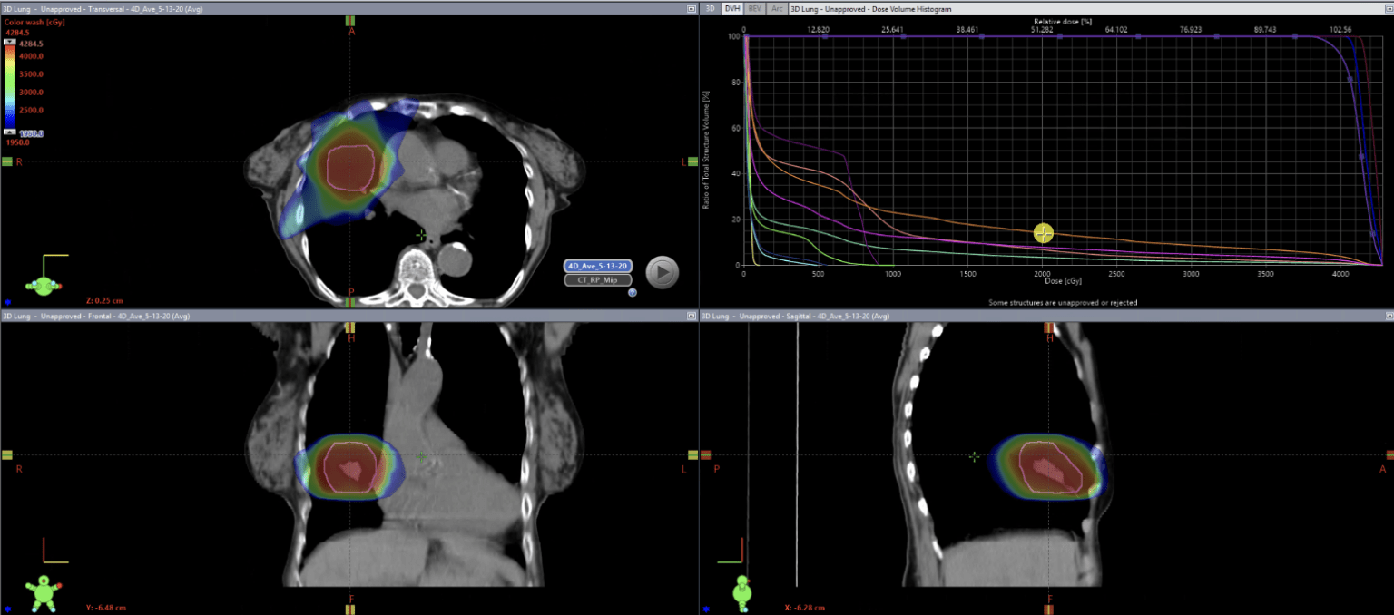 3D Eclipse Lung Planning - MDS School