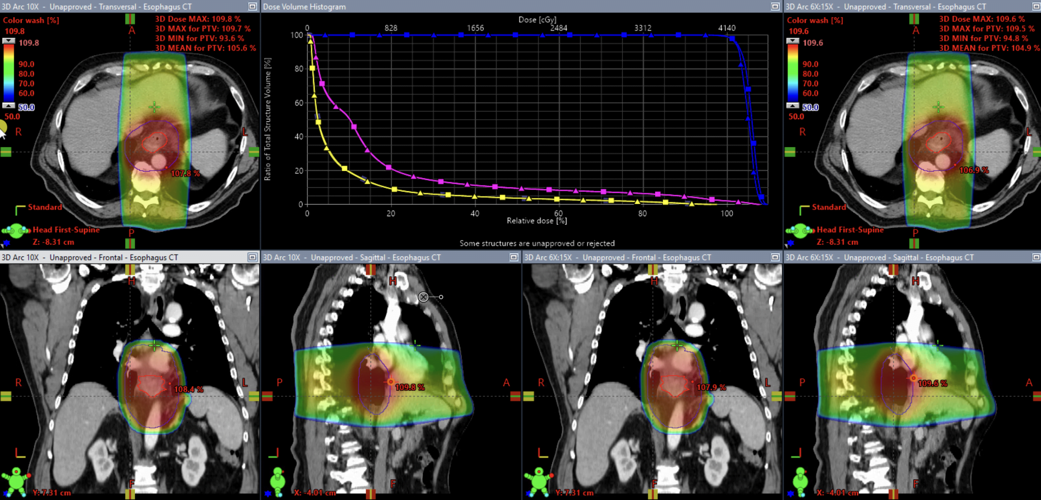 3D Eclipse Esophagus Planning - MDS School