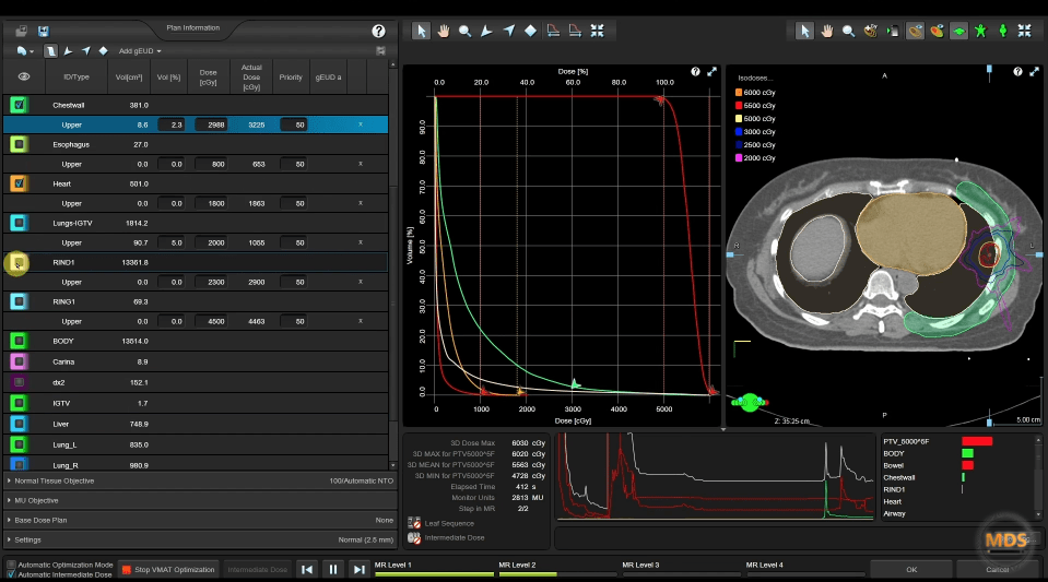 SBRT Eclipse Lung LLL Planning - MDS School