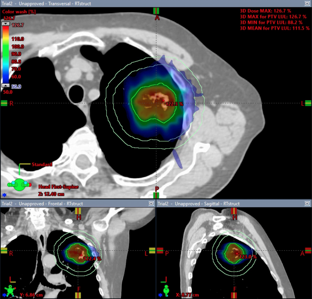 SBRT Eclipse Lung LUL Planning - MDS School